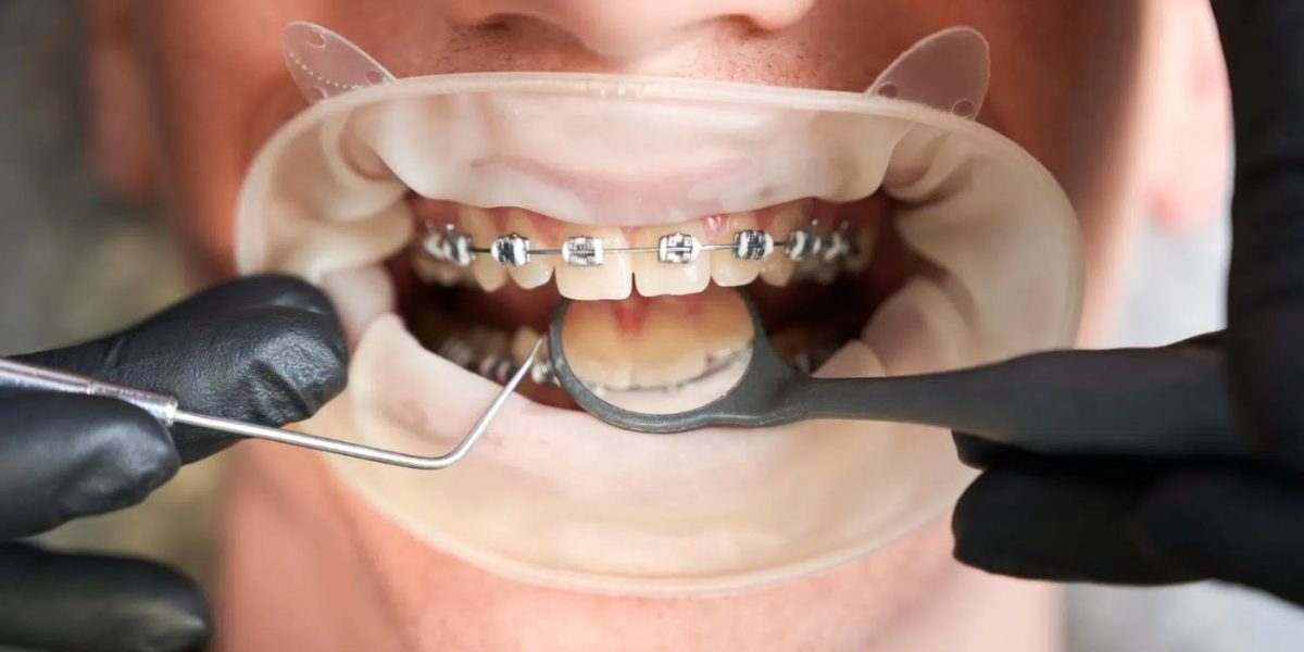 9 Impressive Health Benefits of Straight Teeth