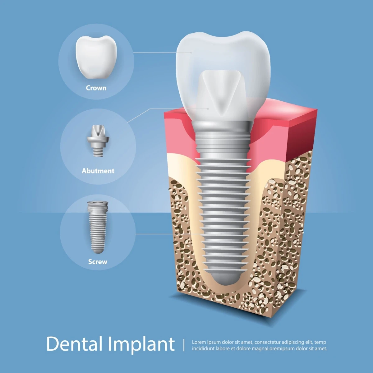 Dental Bridge Cost UK | Hayes Dental Clinic | Middlesex